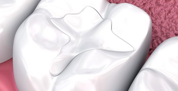 White Fillings – Kingsland Dental